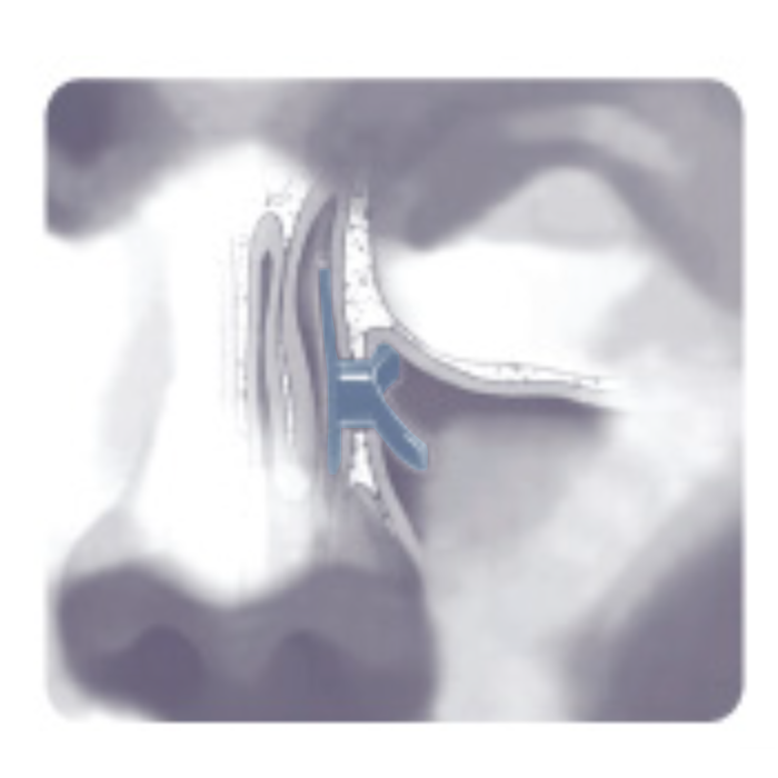 Shikani Middle Meatal Antrostomy Stents . Anthony Products